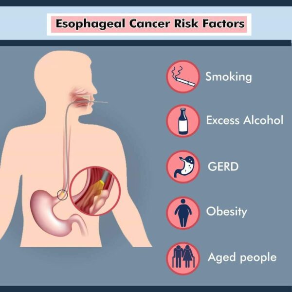 Causes of Esophageal Cancer: Major Risk Factors Explained
