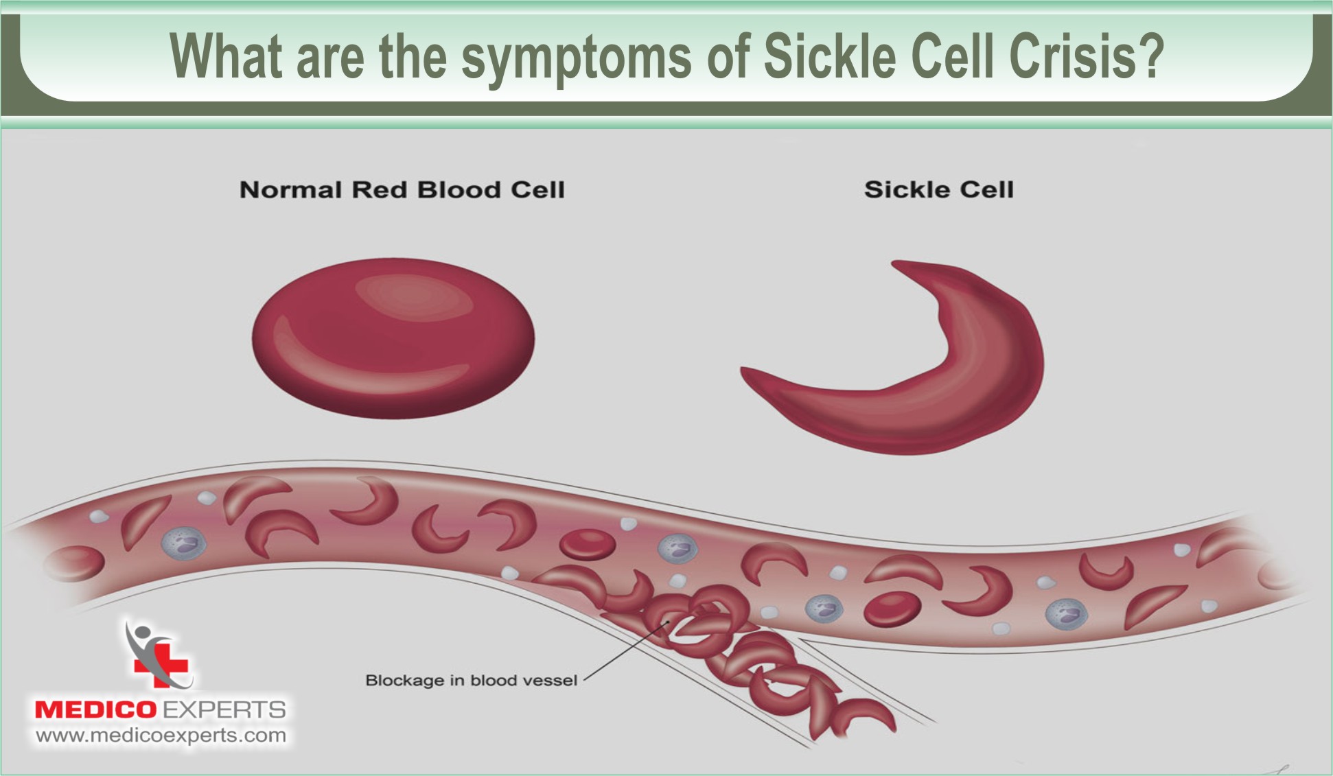 Avoid sickle cell crisis with bone marrow transplant