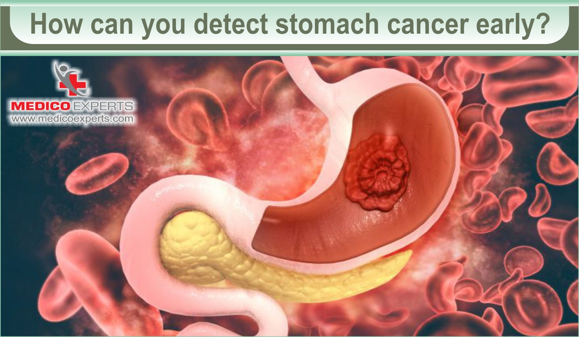 Is Stomach Cancer Curable in India?