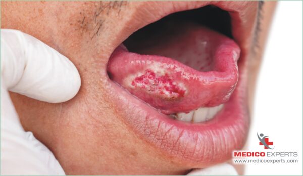 How Long Does Oral Cancer Take to Spread? Signs & Treatment