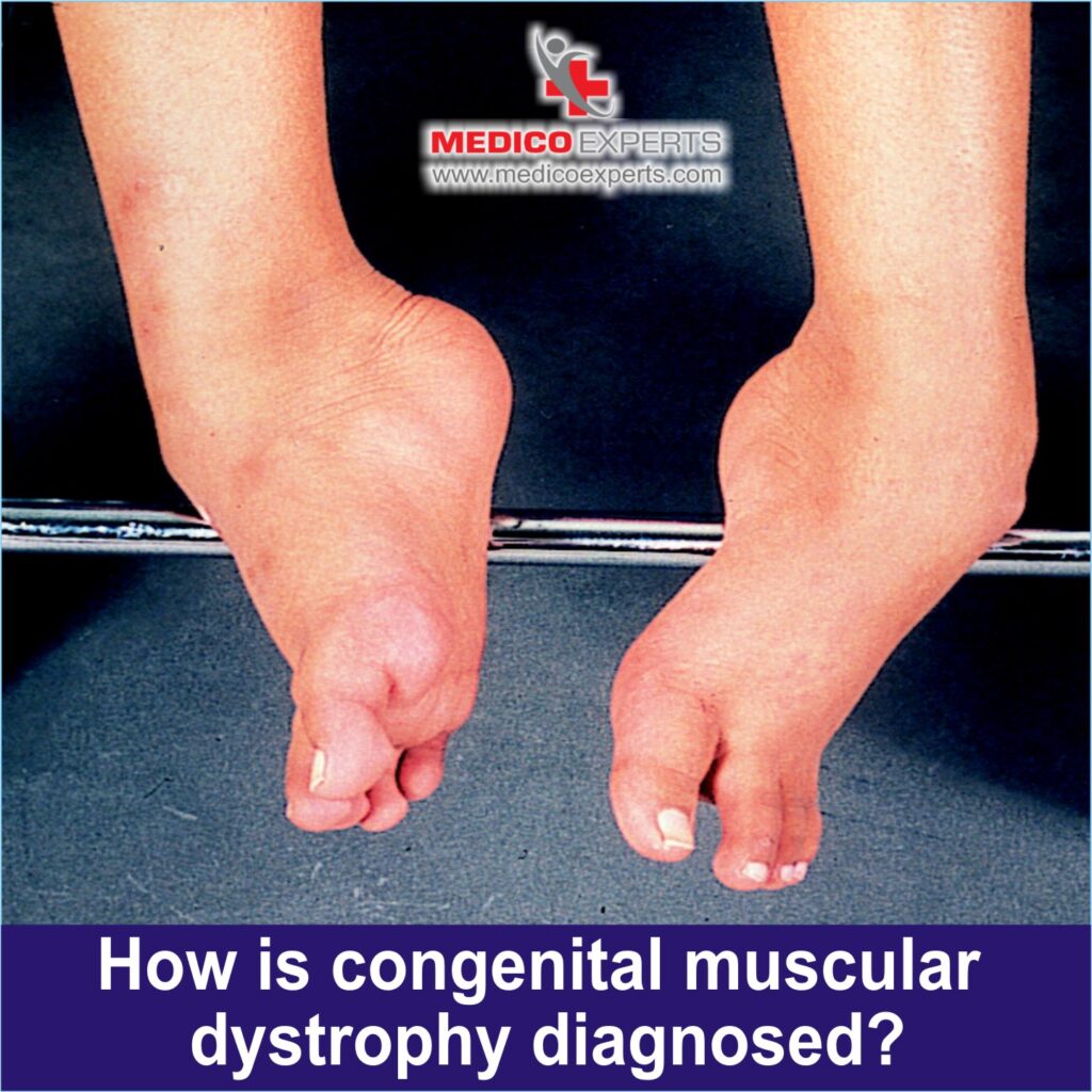 Congenital Muscular Dystrophy: Causes & Treatment Options
