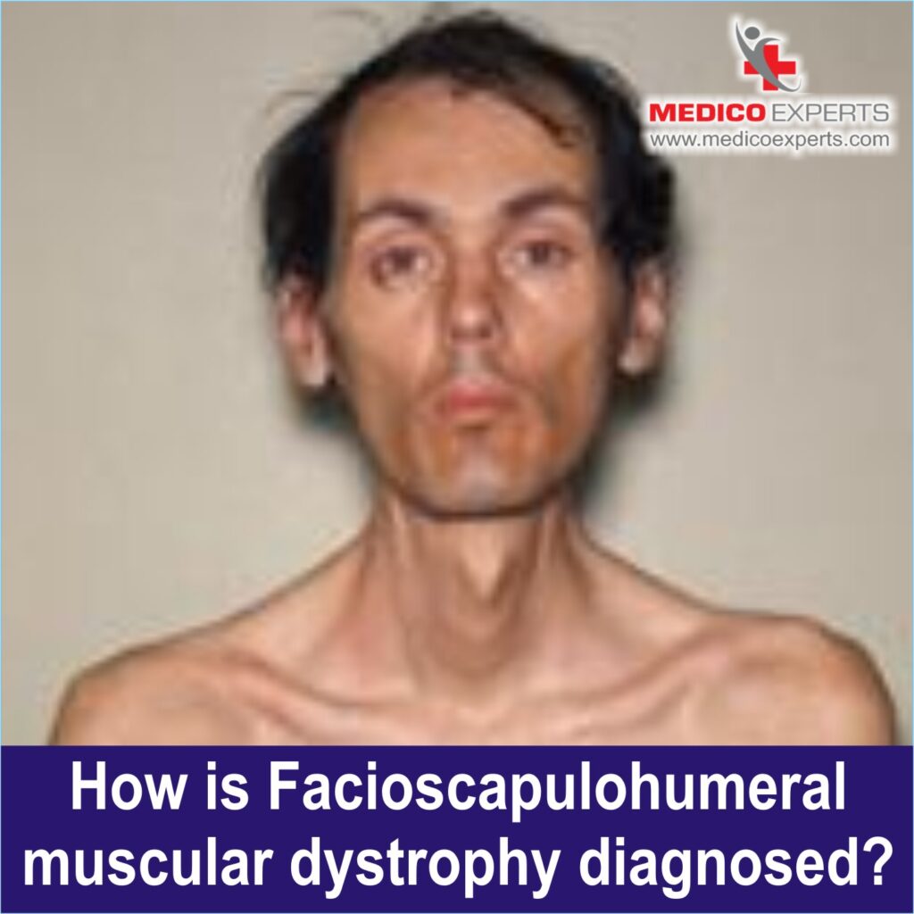 Facioscapulohumeral Muscular Dystrophy: Stem Cell Treatment