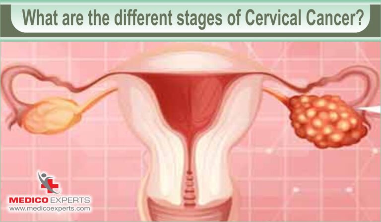 Cervical Cancer Stages and Treatment: Raising Awareness