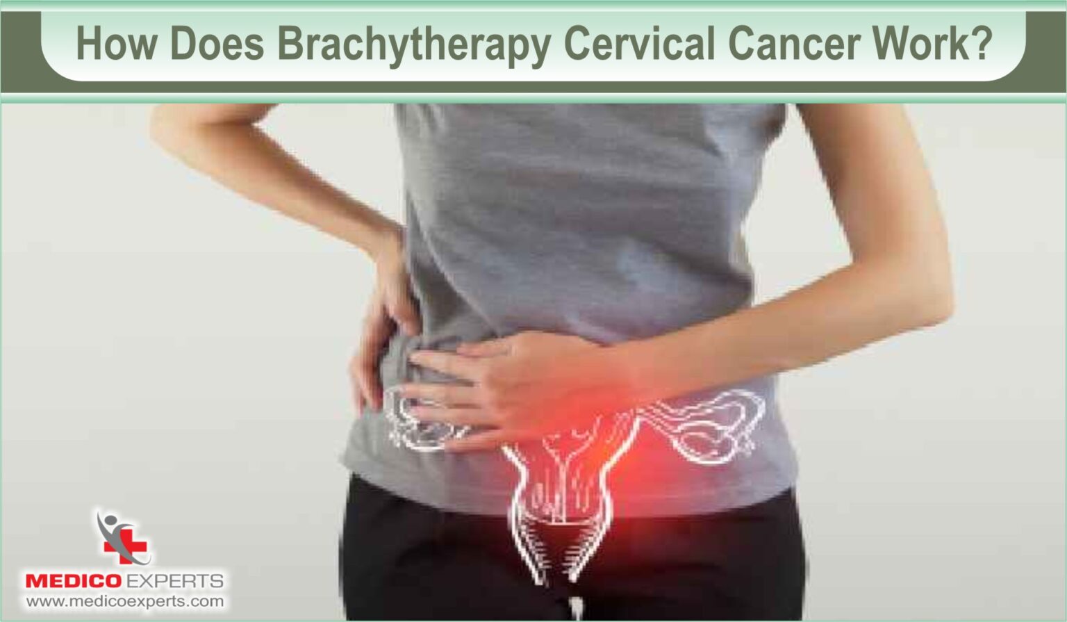 Effectiveness of Brachytherapy for Cervical Cancer