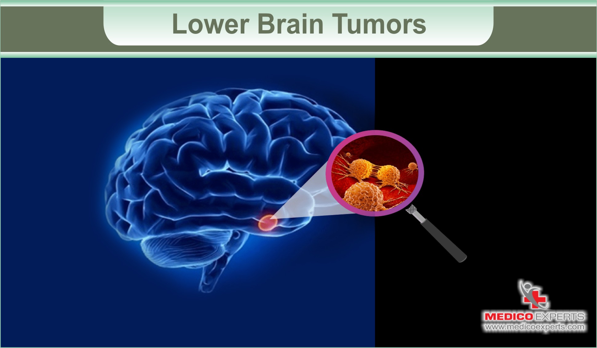 Brain Tumor Symptoms: Learn to save lives