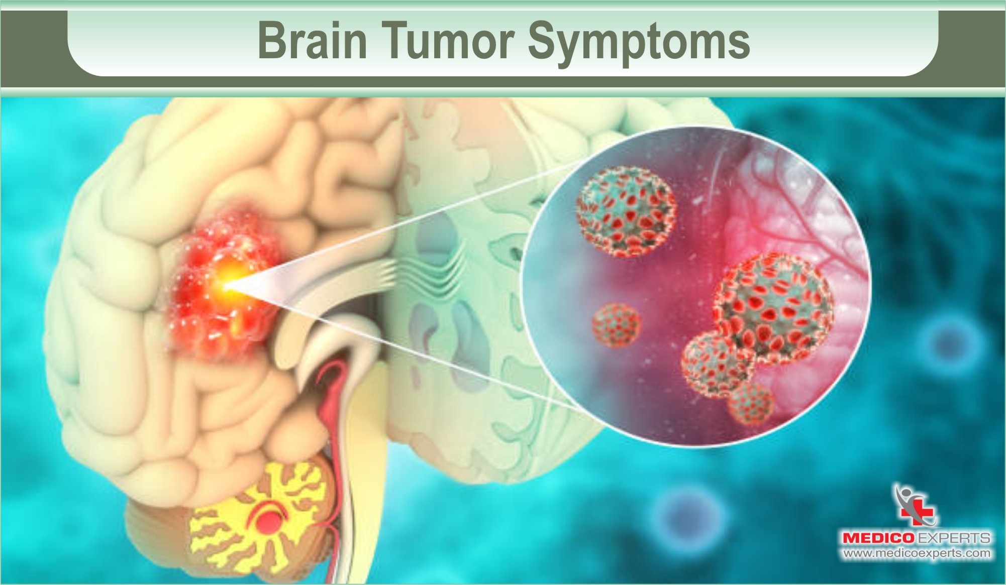 Brain Tumor Symptoms: Learn to save lives