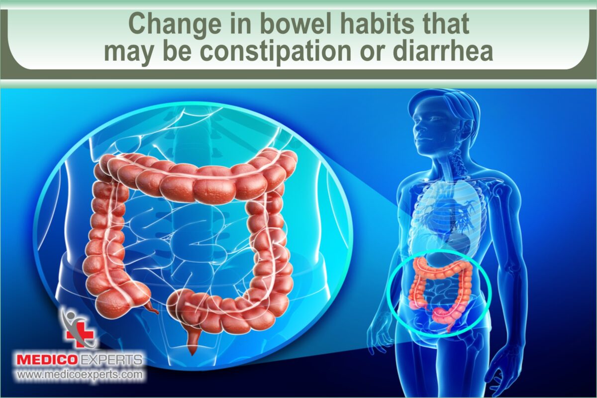 9 Early Colon Cancer Signs and Symptoms