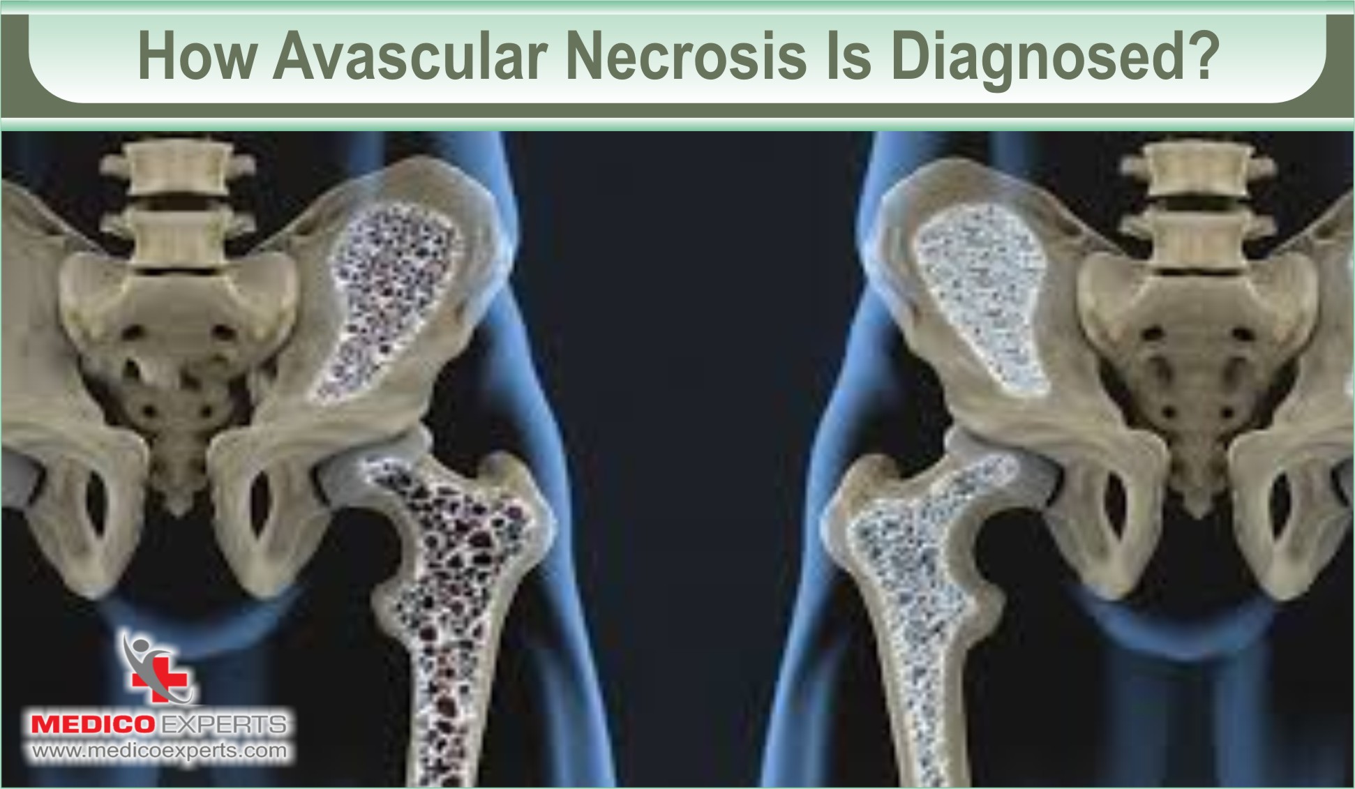 Answered: Can Avascular Necrosis be Reversed?