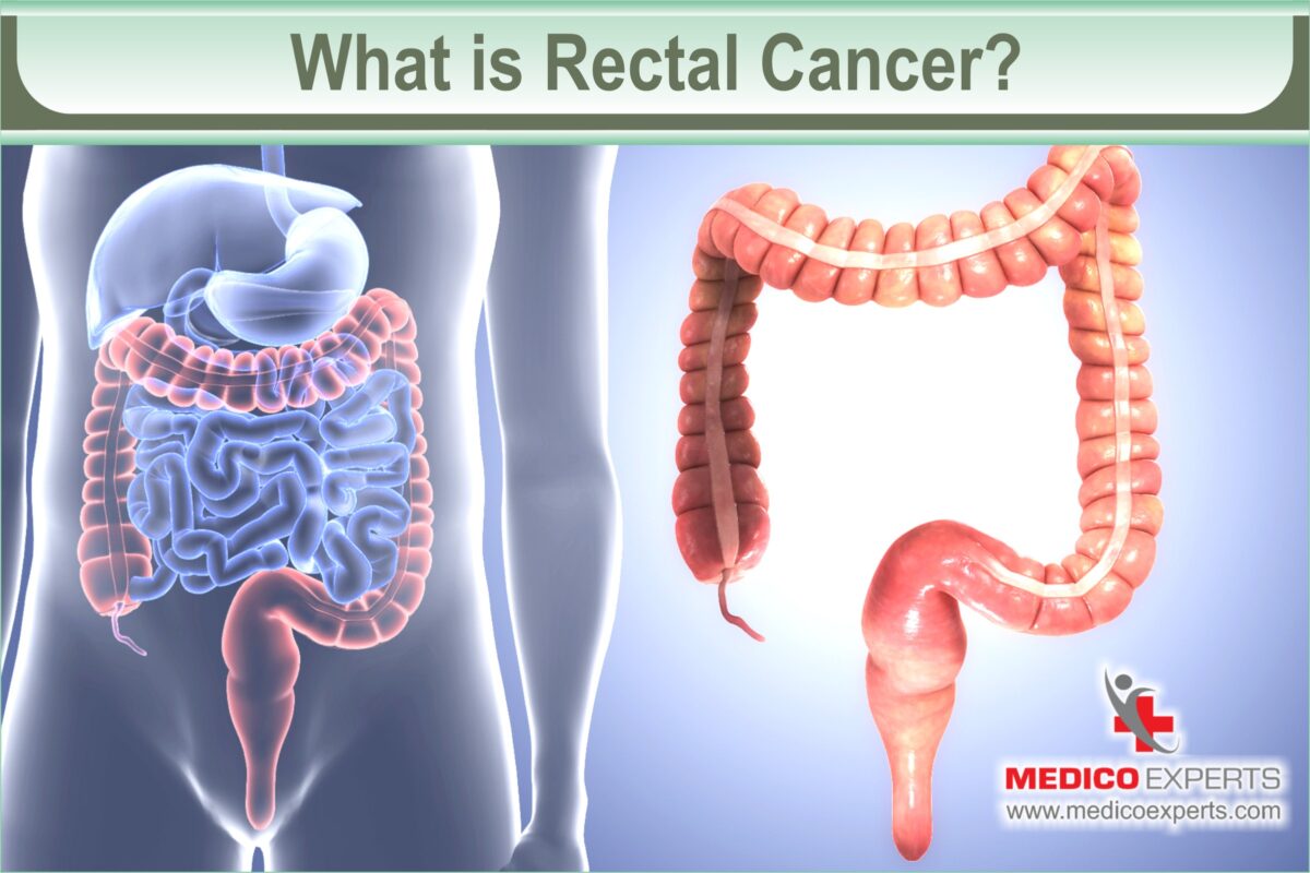 Rectal Cancer Surgery: Exploring Surgical Approaches and Treatment Choices