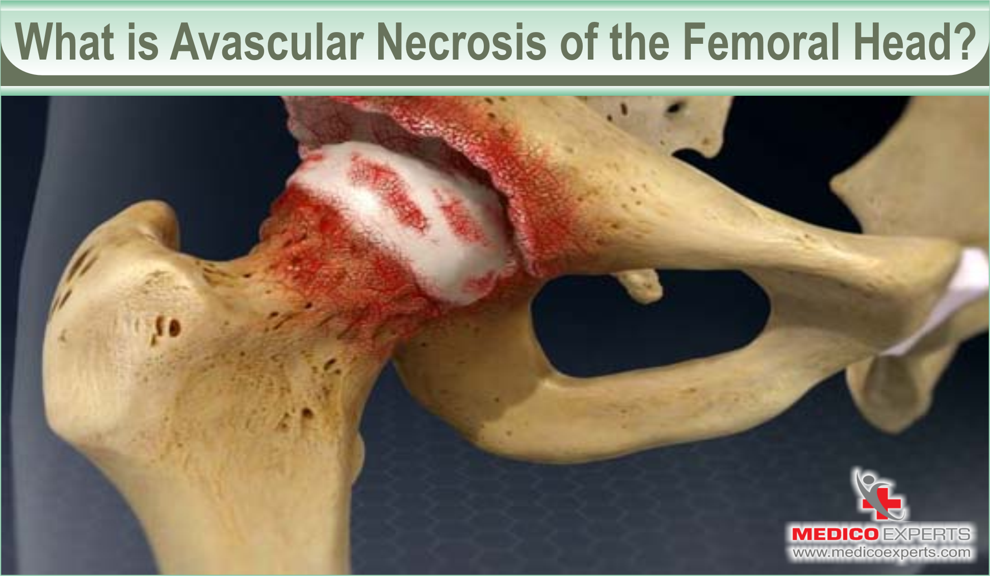 Most Effective Avascular Necrosis of Femoral Head Treatment