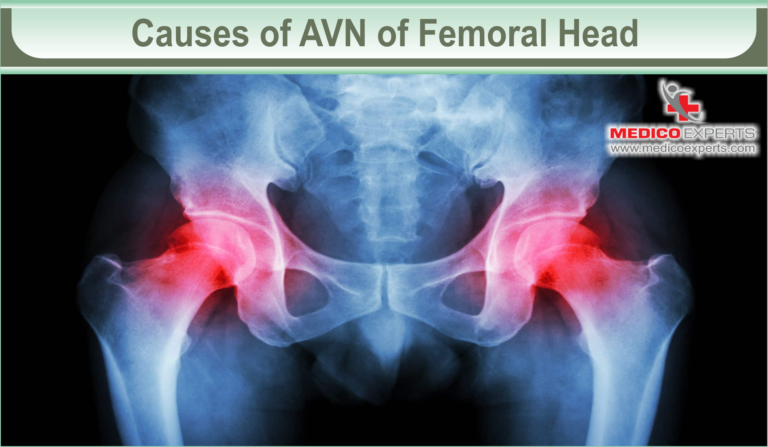 Most Effective Avascular Necrosis of Femoral Head Treatment