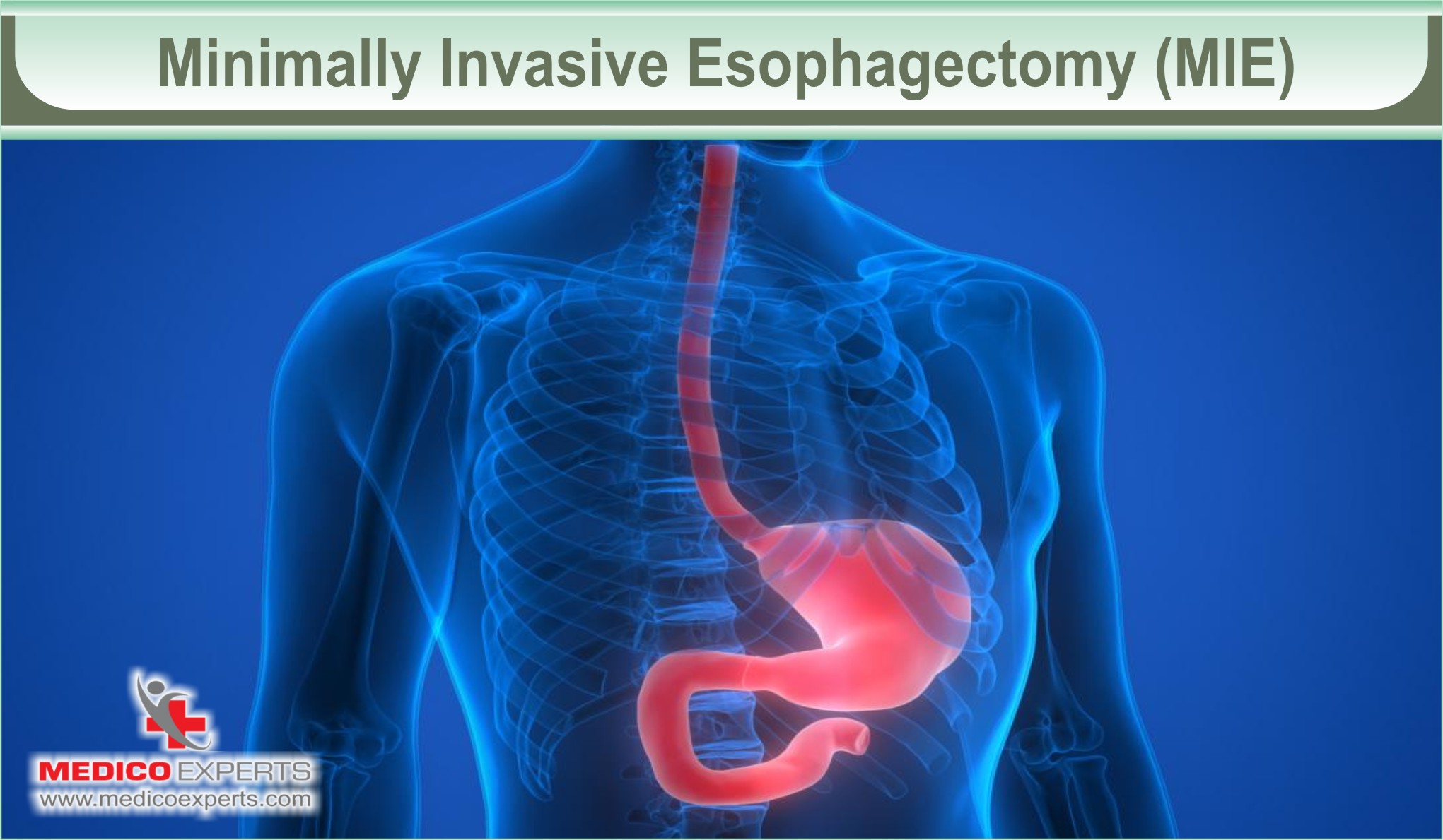 Esophagectomy Surgery: Procedure, Risk, & Benefits