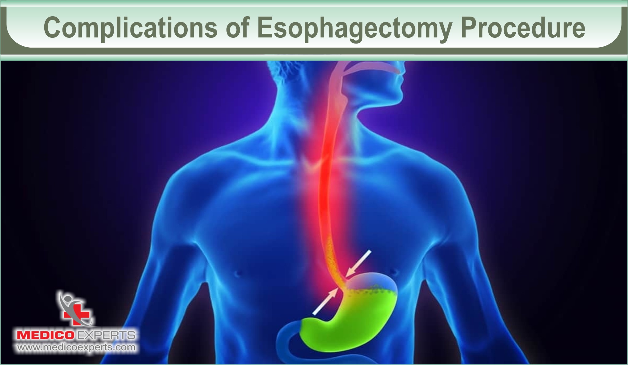 Esophagectomy Surgery: Procedure, Risk, & Benefits