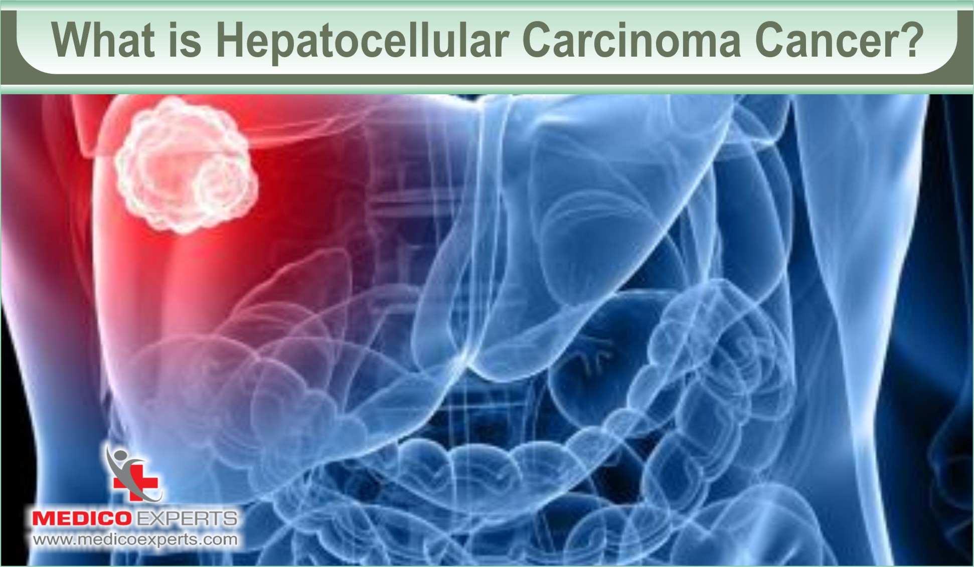 Hepatocellular carcinoma treatment to cure your liver