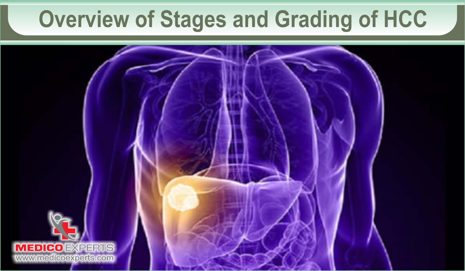 Hepatocellular carcinoma treatment to cure your liver