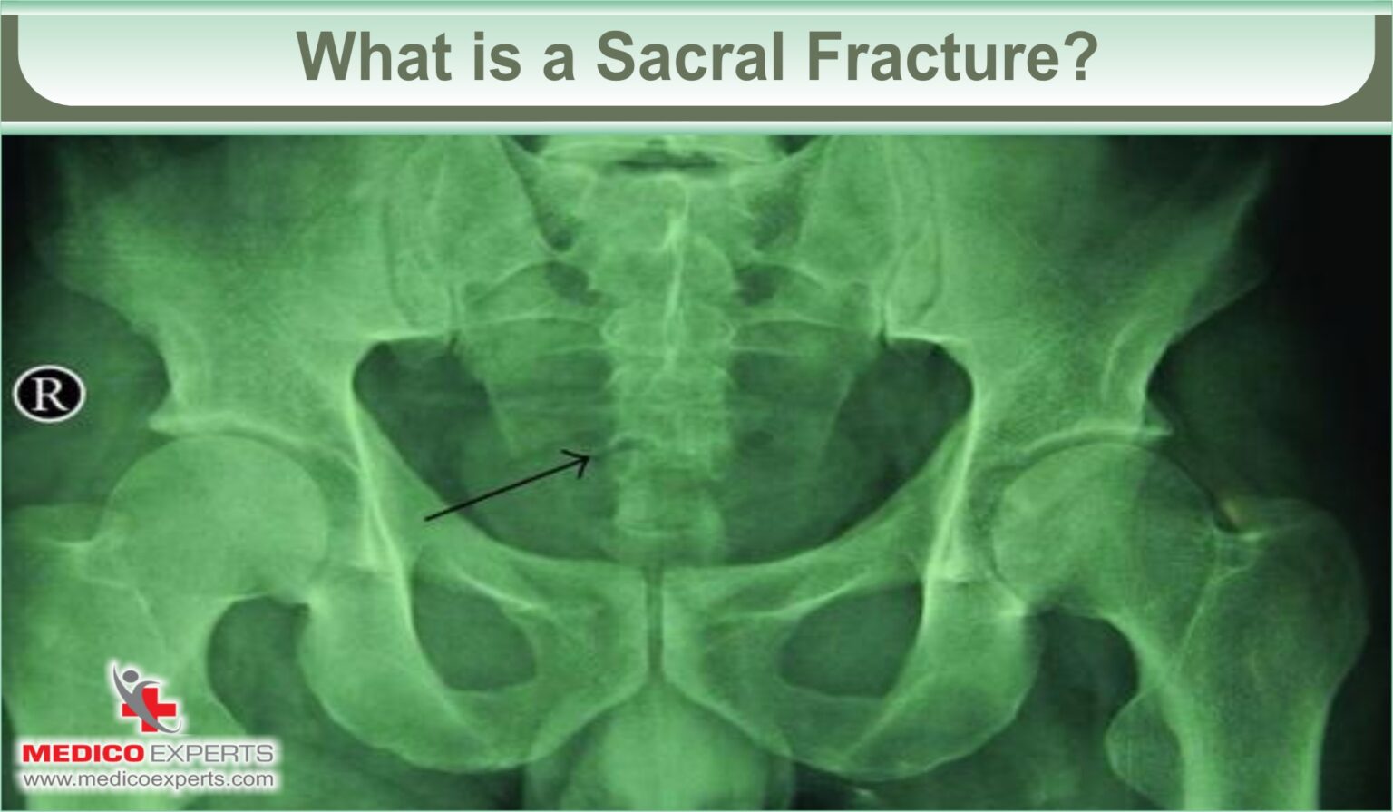 Sacral Fracture Treatment: Regain Mobility & Comfort Fast