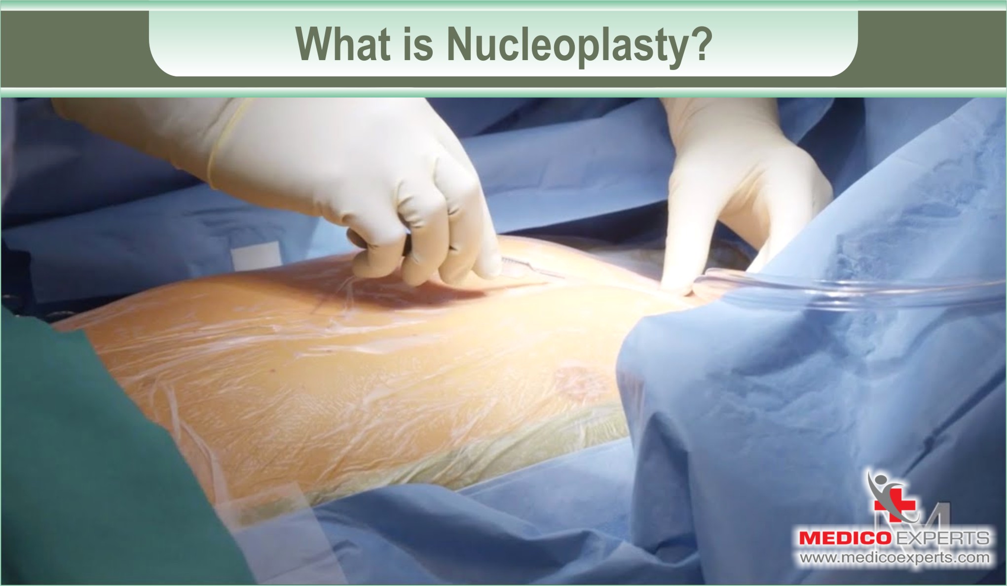 Understanding Nucleoplasty: Key Facts and Benefits