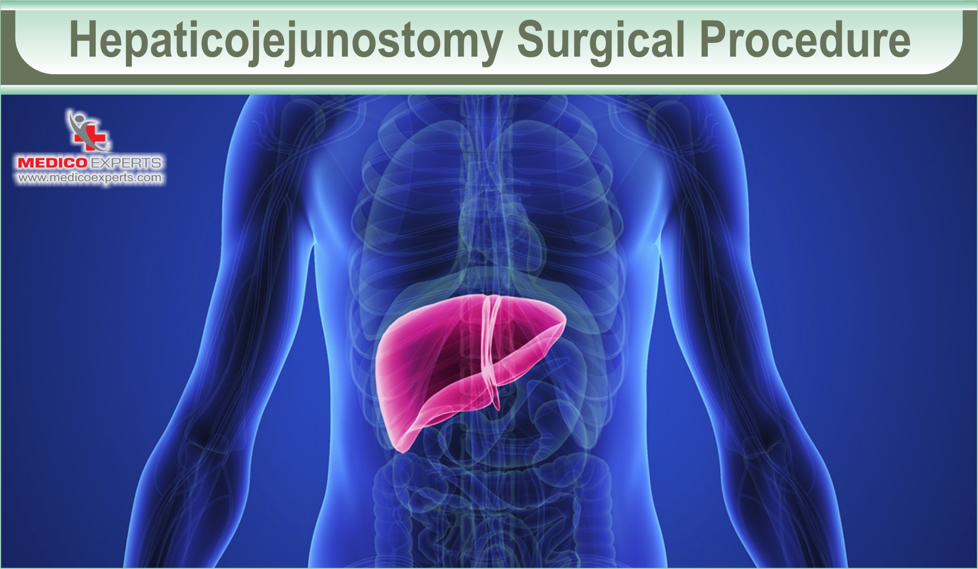 Hepaticojejunostomy Surgery: Your Key to a Healthier Liver