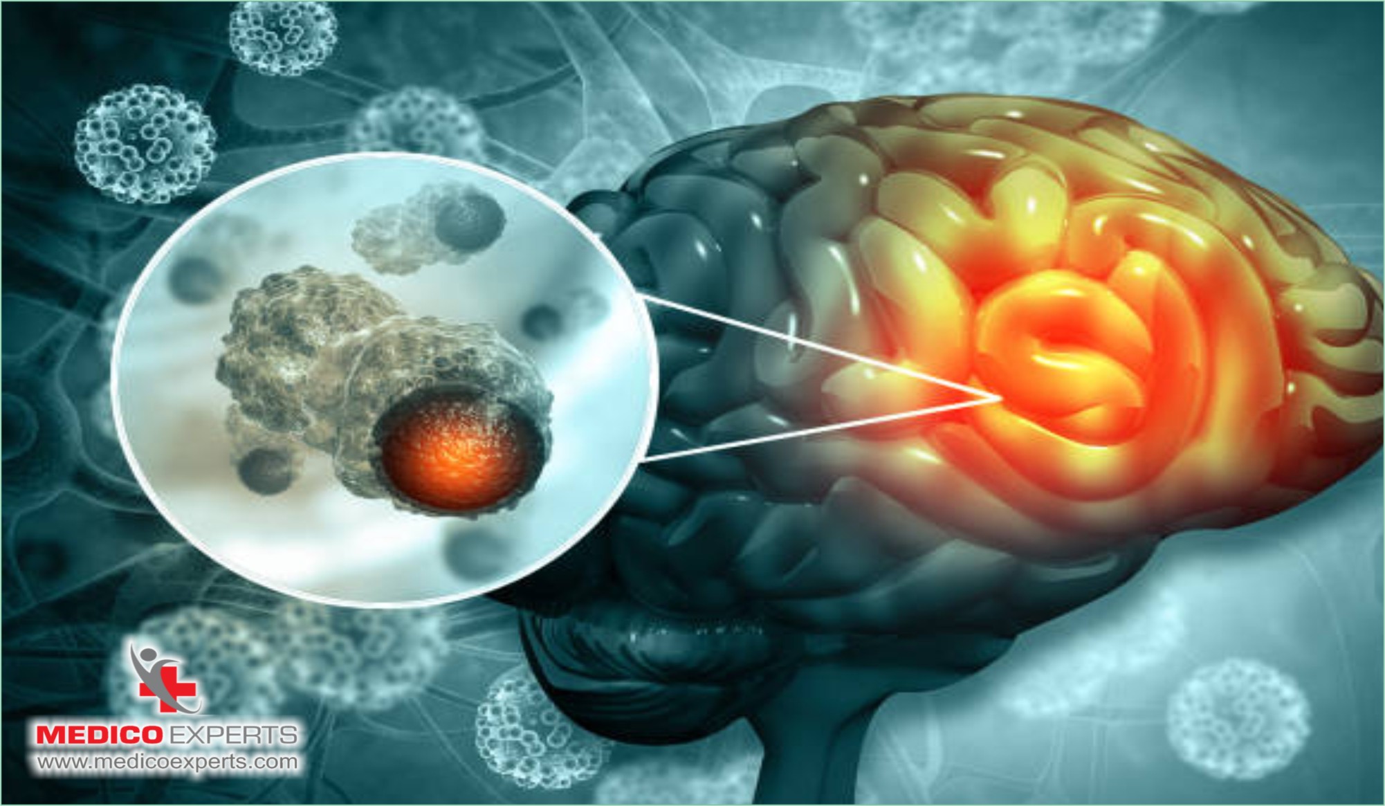 Advanced Motor Neuron Disease Treatment in India
