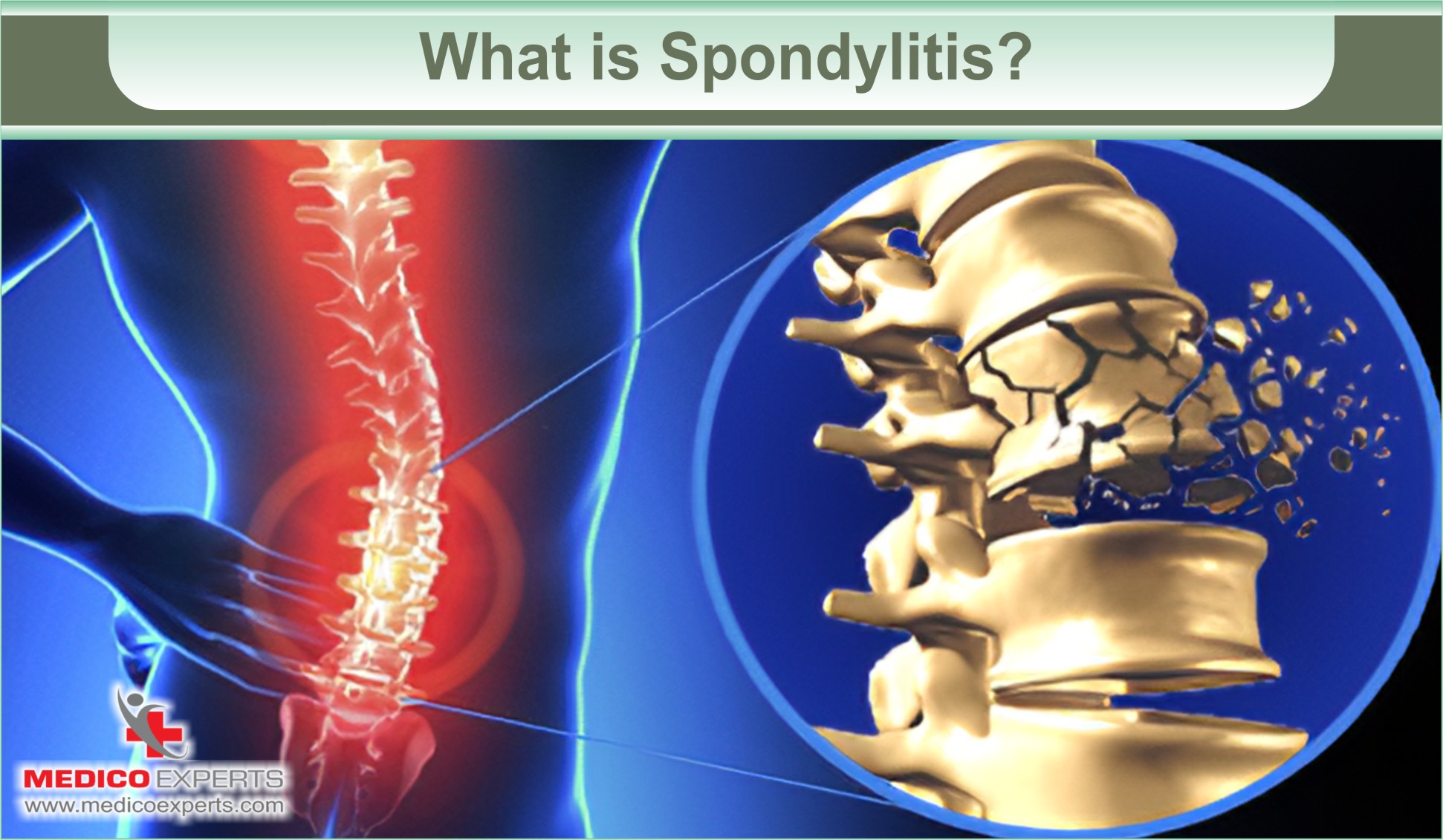 Live Pain-free: Best Treatment for Spondylitis