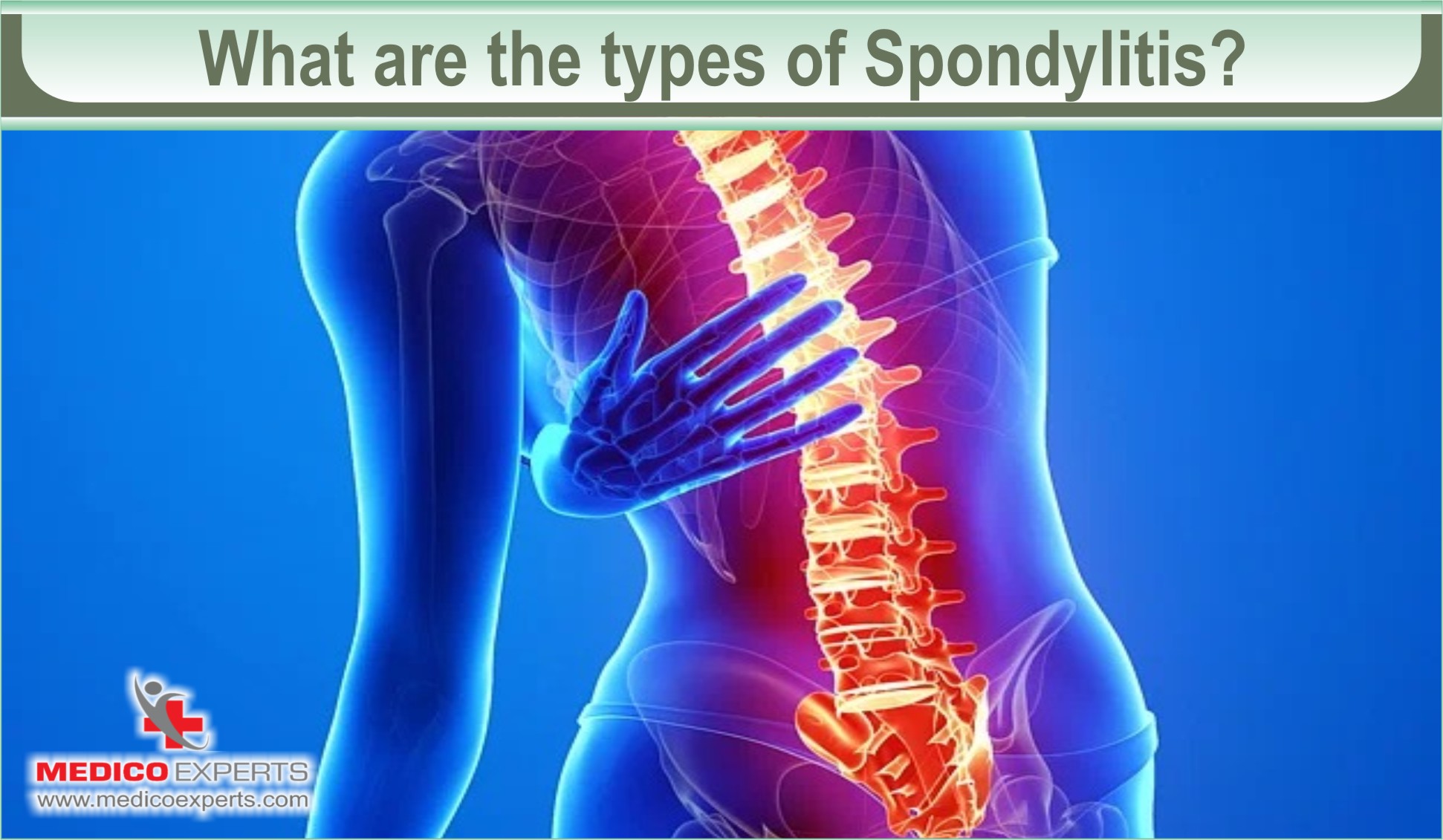 Live Pain-free: Best Treatment for Spondylitis