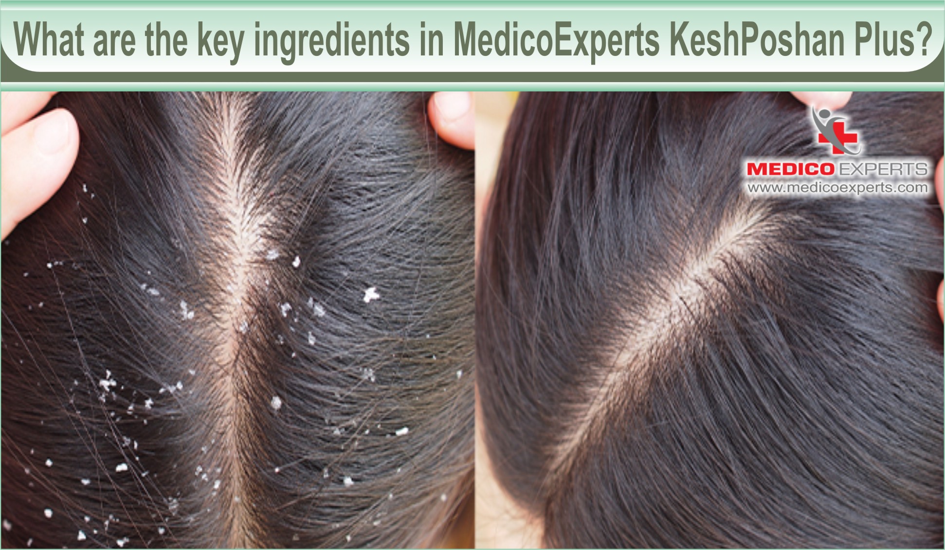 Naturally Clear: Ayurvedic Treatment for Dandruff