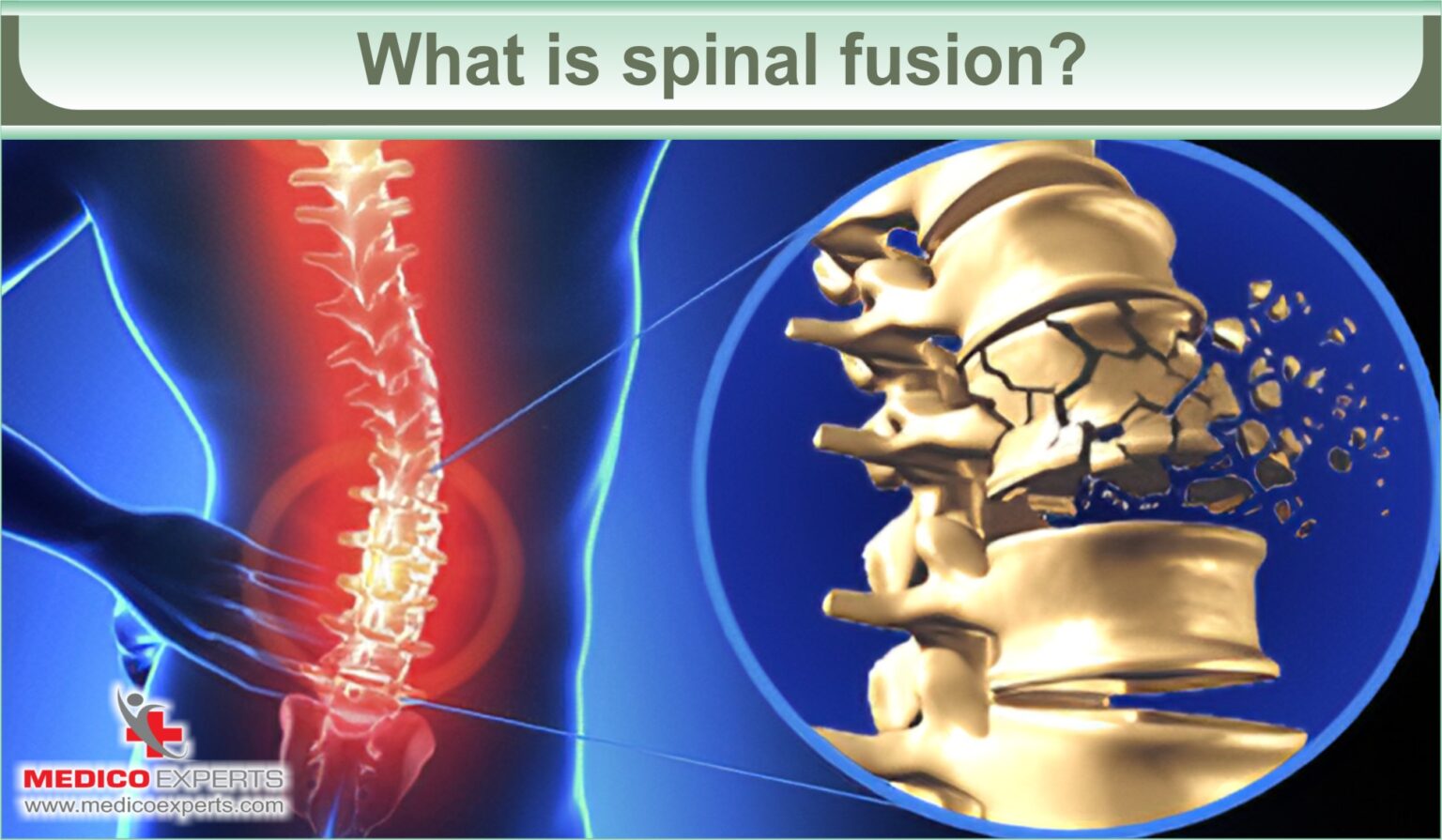 Spinal Fusion Surgery for Back Pain Relief
