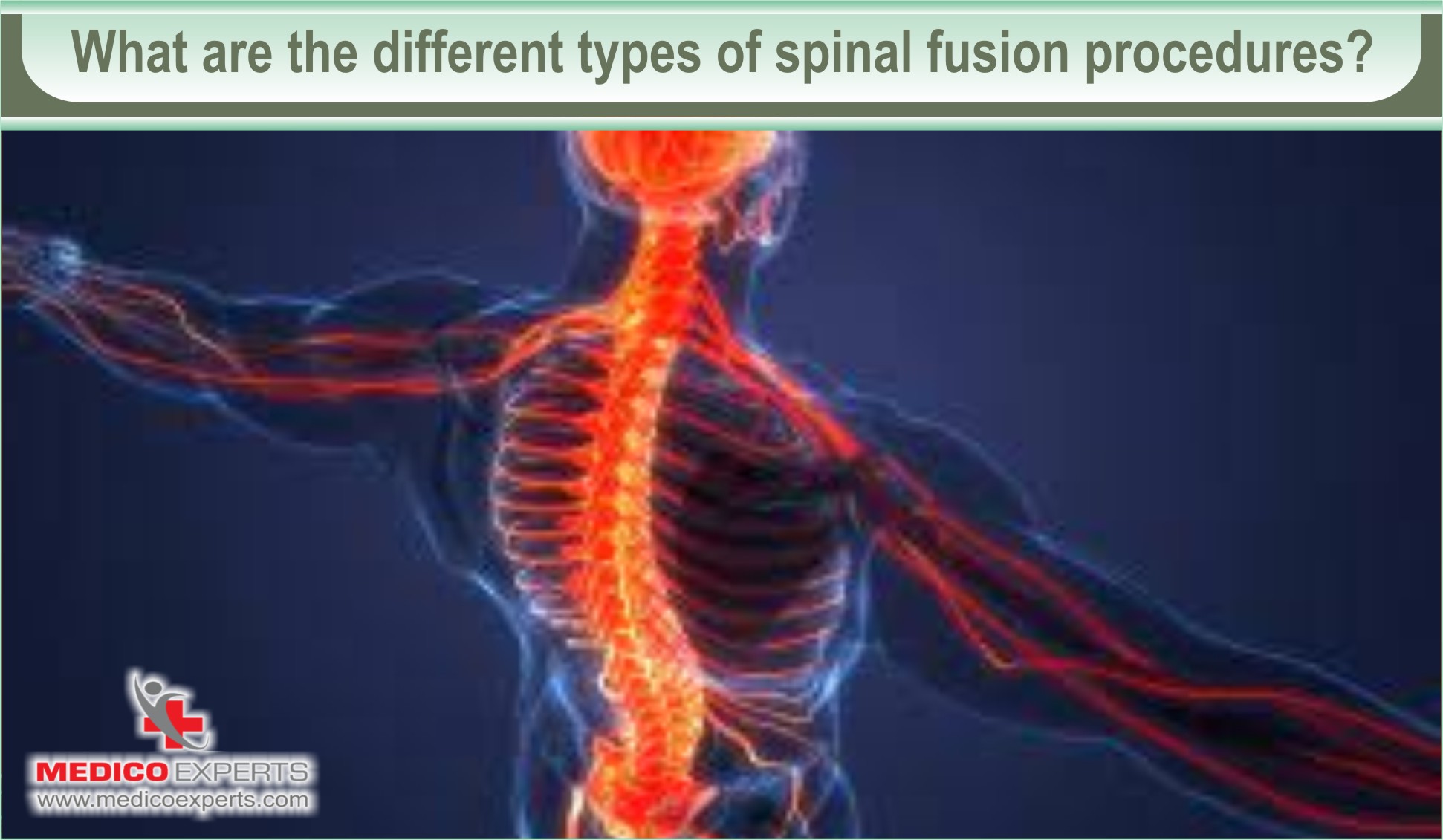 Spinal Fusion Surgery for Back Pain Relief