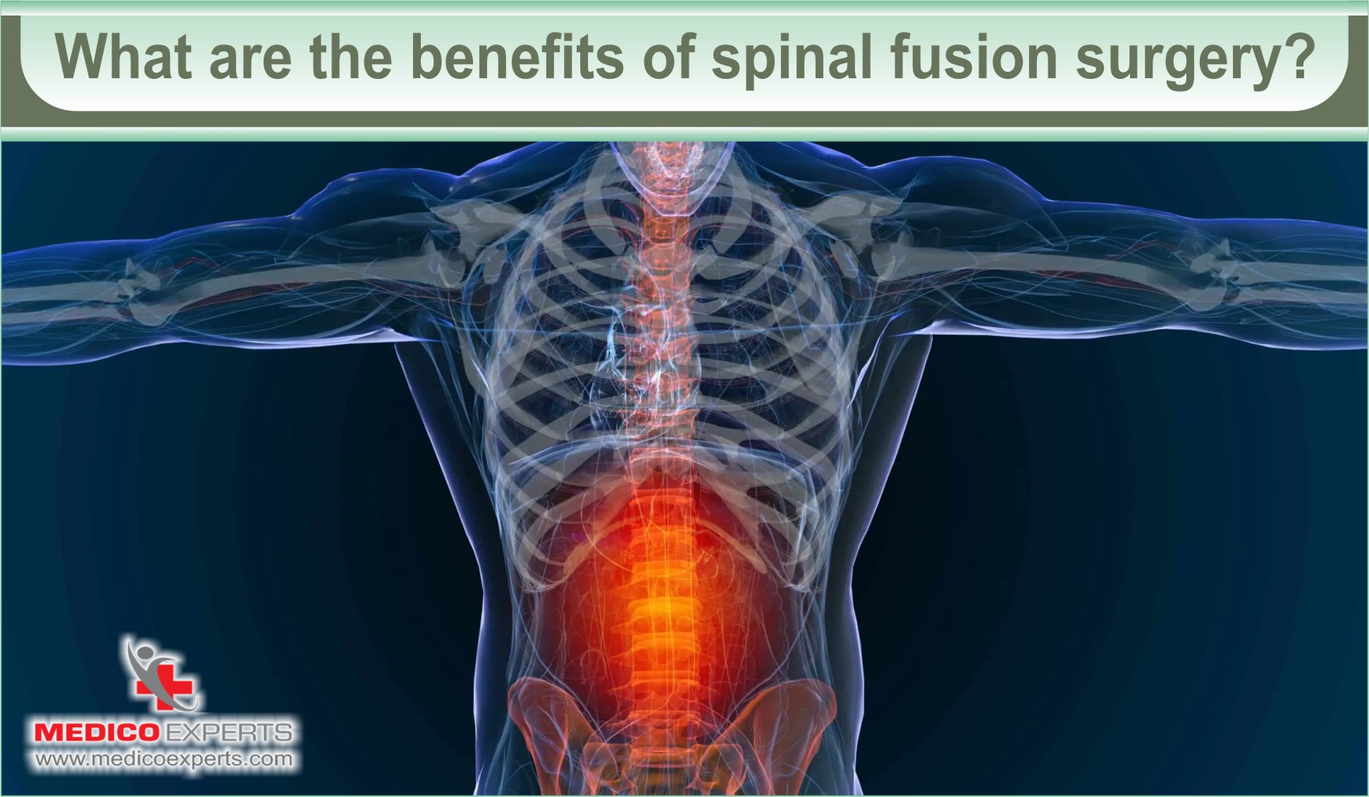 Spinal Fusion Surgery for Back Pain Relief