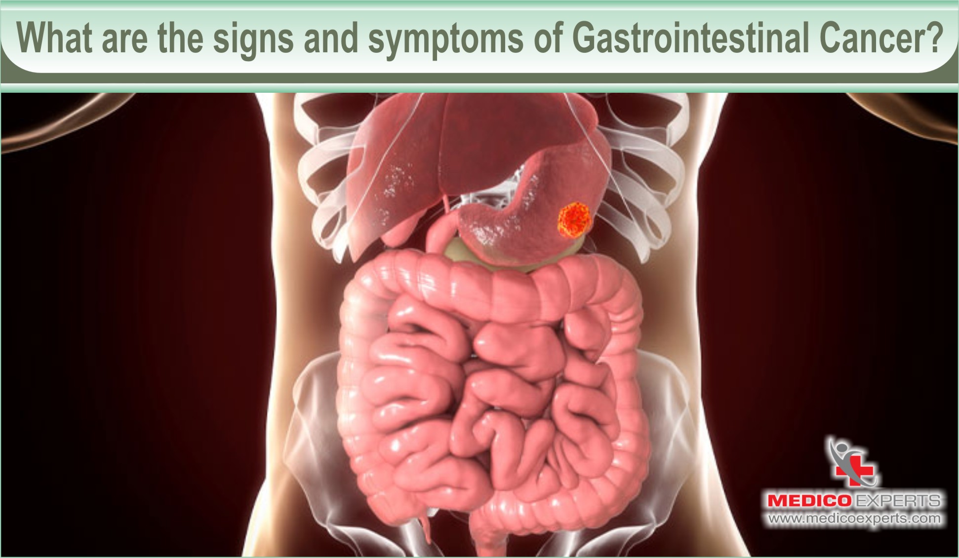 Decoding: Is Gastrointestinal Cancer Curable?