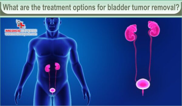 Bladder Tumor Removal: A Roadmap to Renewed Health