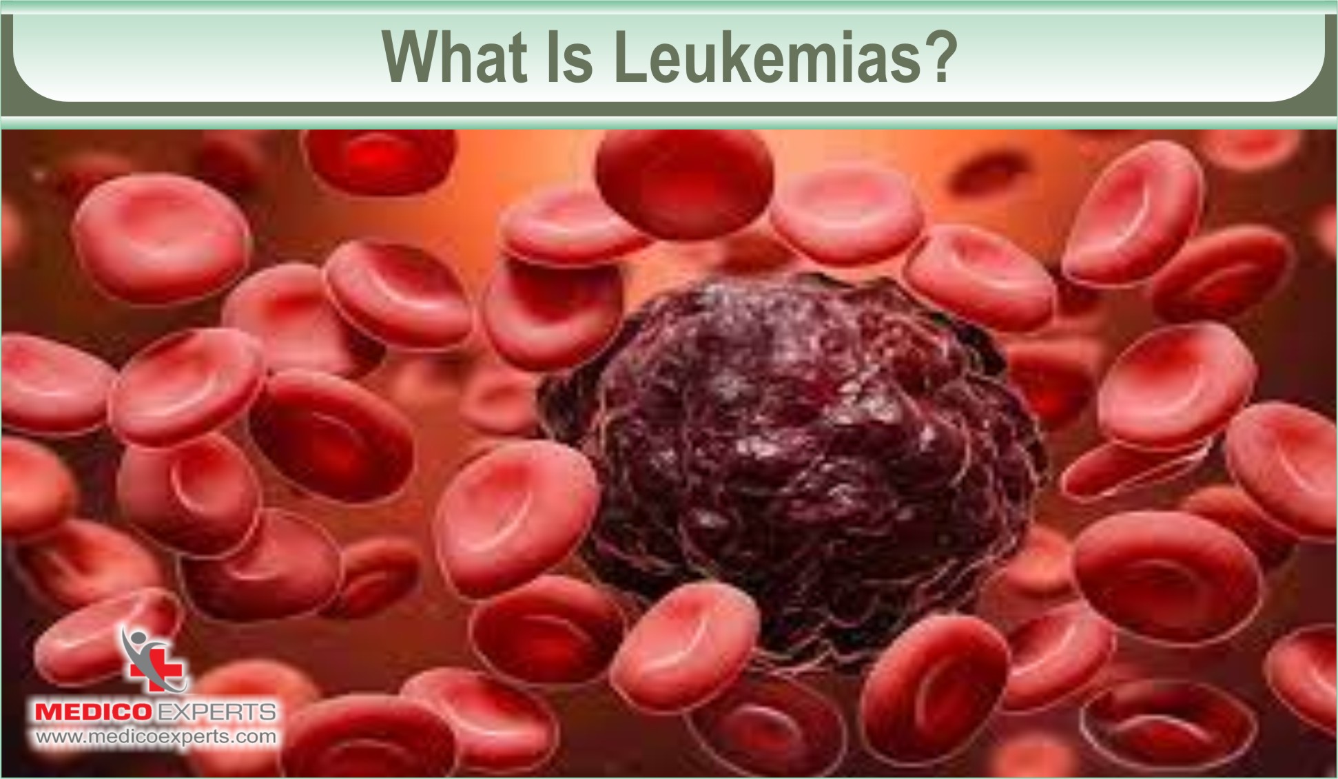 Acute Leukemia in Adults - A Closer Look