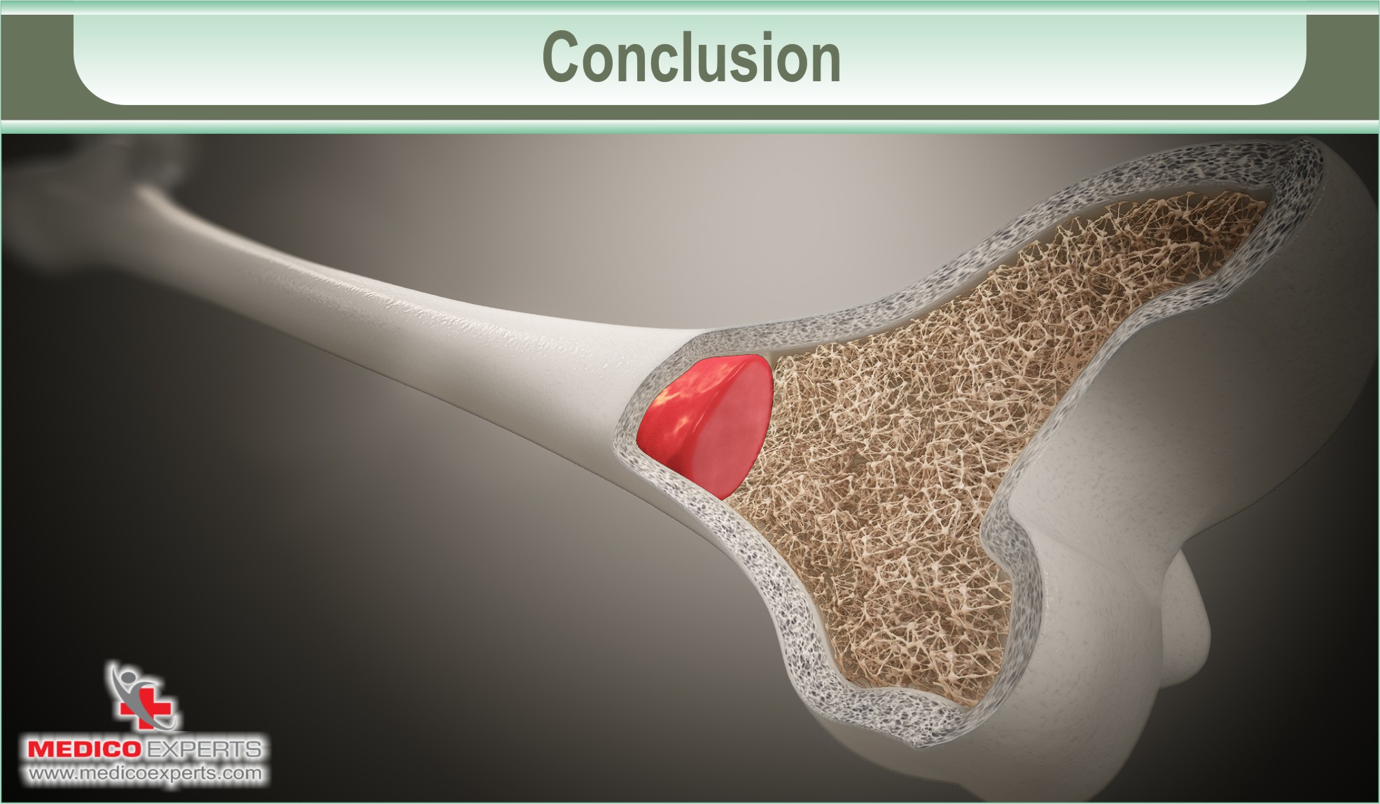 The Miracle Cure: Autologous Bone Marrow Transplant