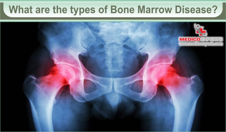 Your Ultimate Guide to Bone Marrow Diseases and Recovery