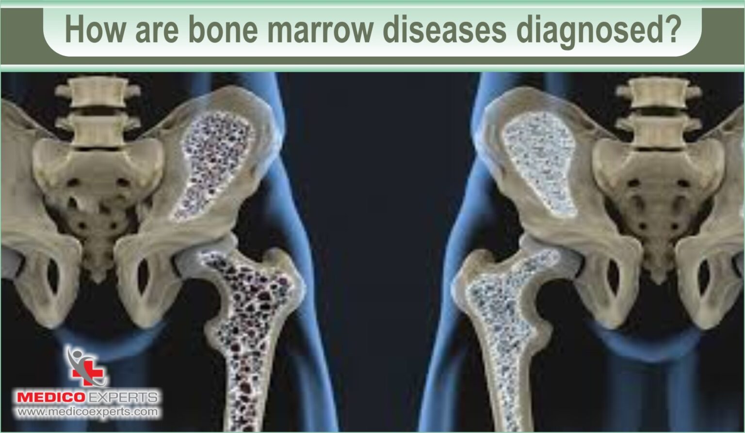 Your Ultimate Guide to Bone Marrow Diseases and Recovery
