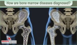 Your Ultimate Guide to Bone Marrow Diseases and Recovery