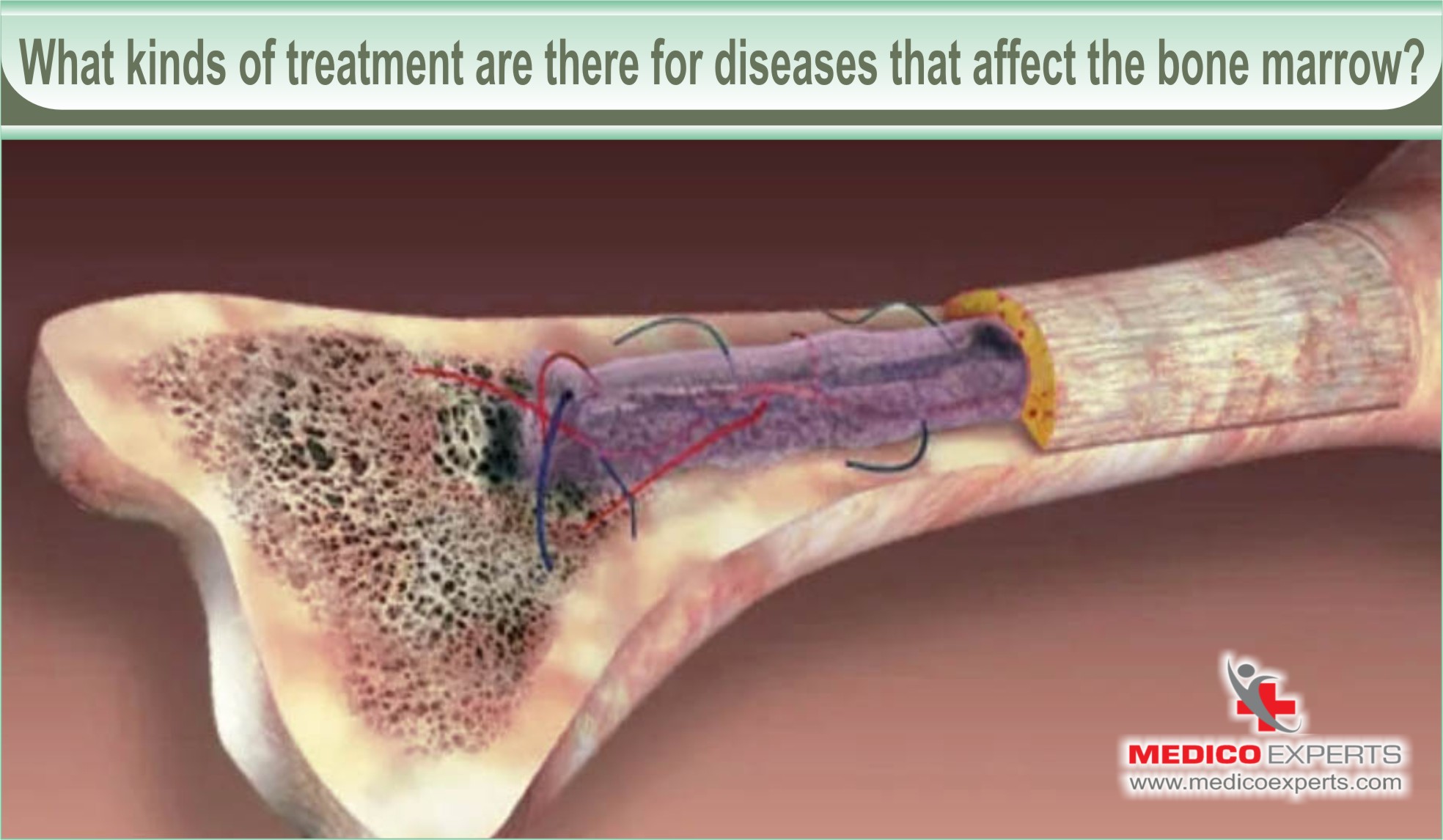 Your Ultimate Guide to Bone Marrow Diseases and Recovery
