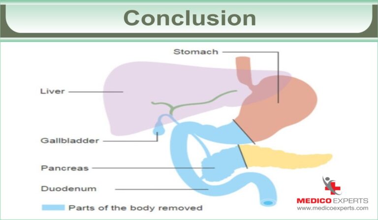 What is Whipple Procedure: A Comprehensive Overview