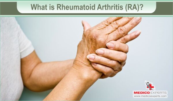What are the Non surgical Treatment Options for Rheumatoid Arthritis
