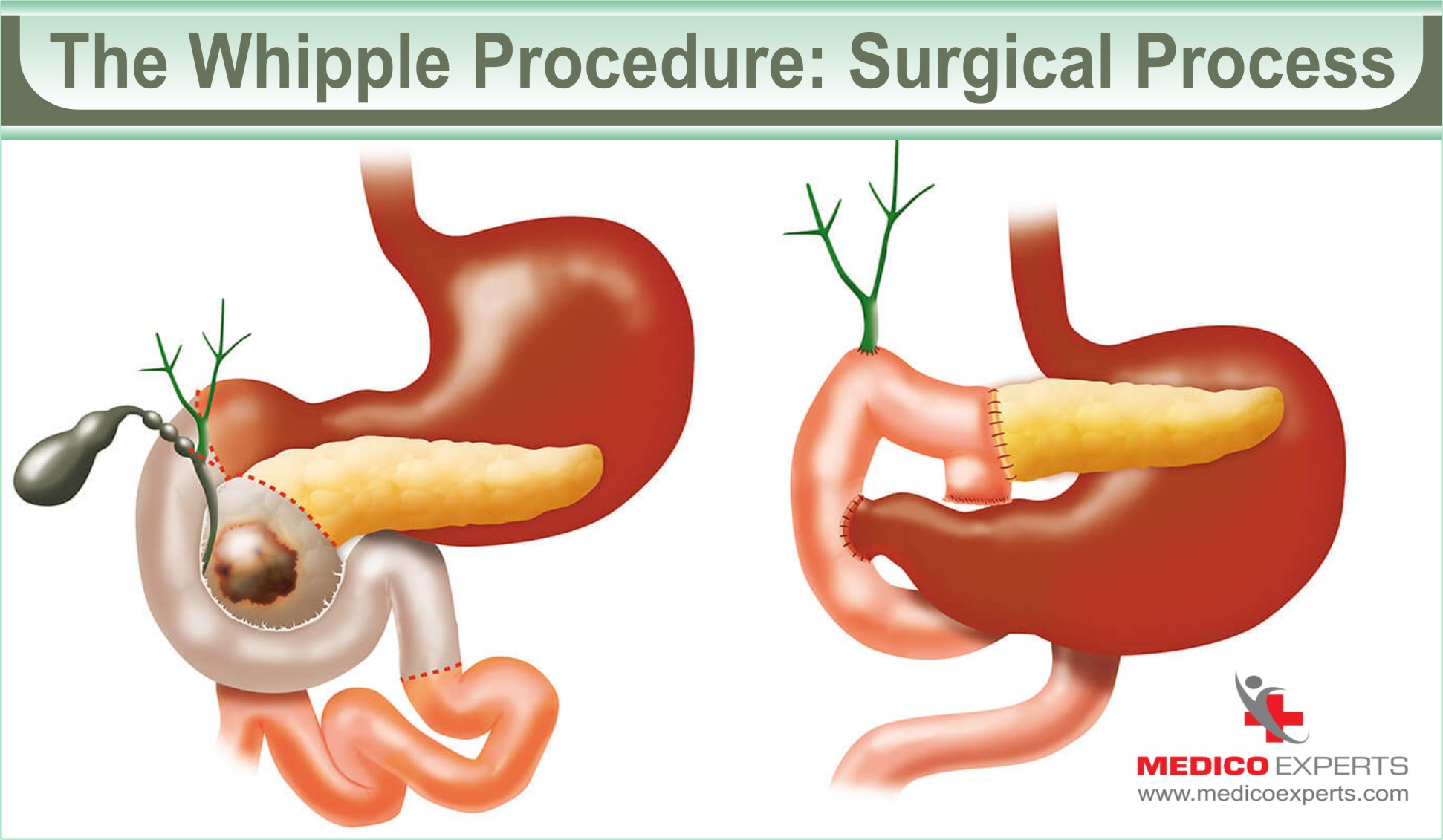 What is Whipple Procedure: A Comprehensive Overview