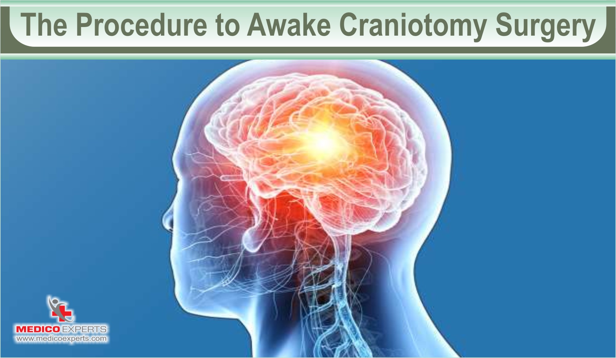 Awake Craniotomy: Revolutionizing Neurosurgery