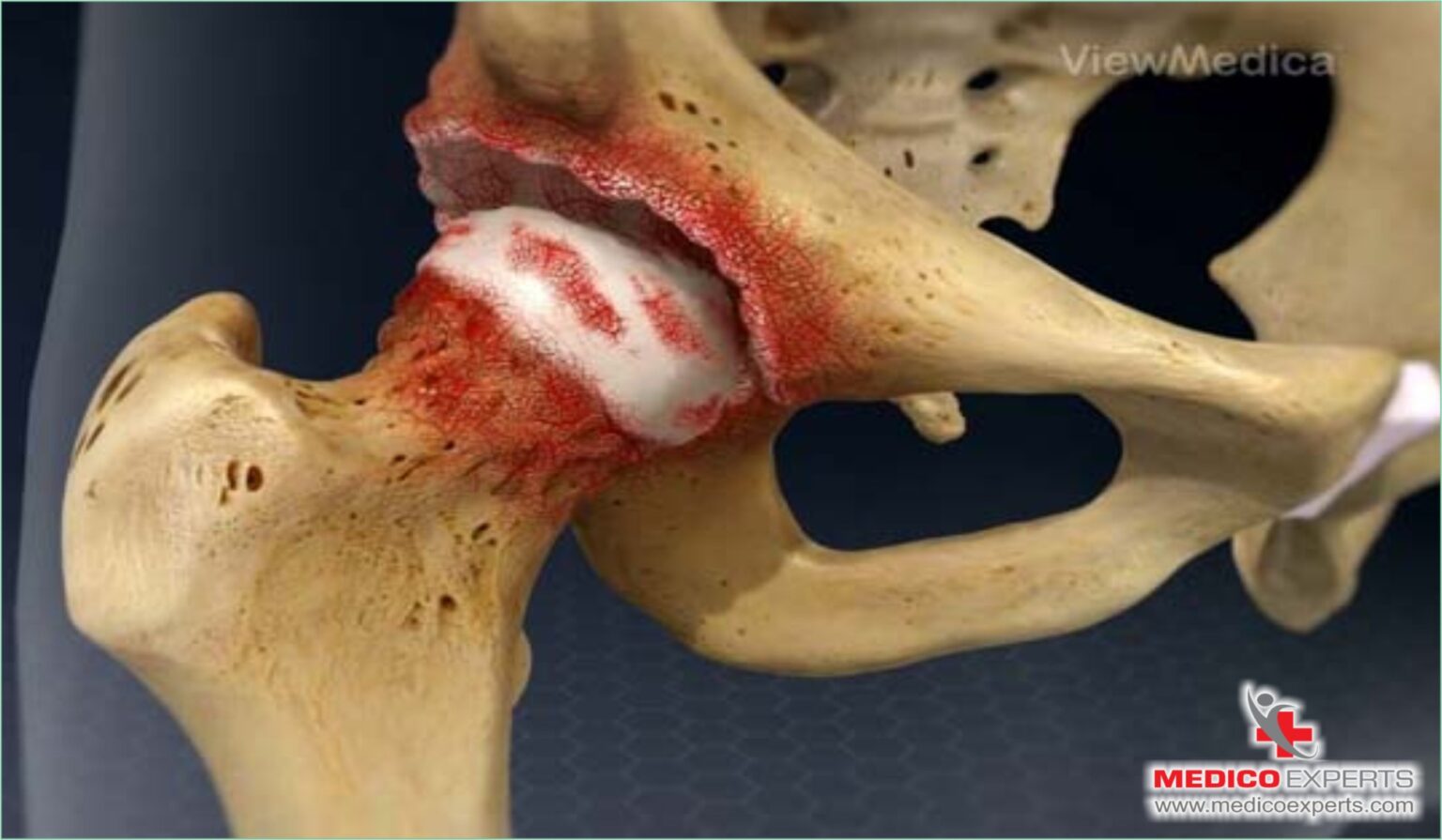 Can Avascular Necrosis Be Reversed? Explore Treatments Now
